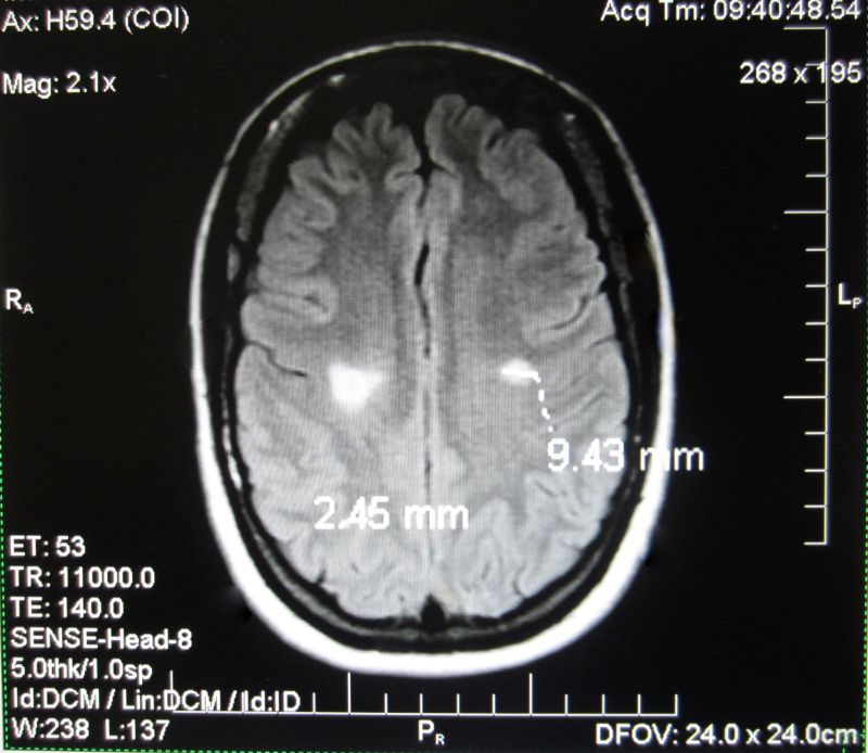 Multiple Sclerosis Research – Somata